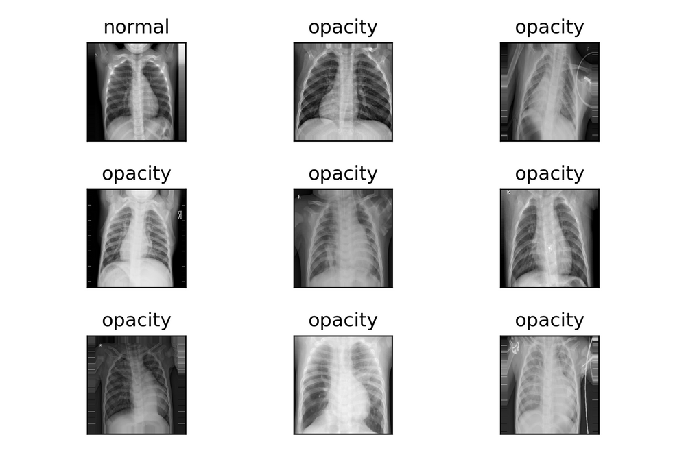 Detecting Pneumonia in Chest X-Ray Images Using Deep Learning Models on ...