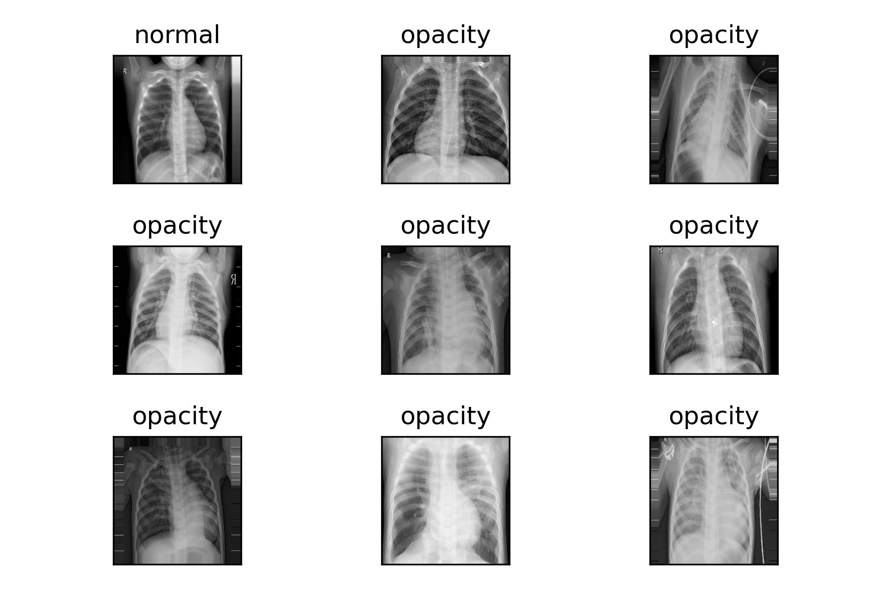 Detecting Pneumonia in Chest X-Ray Images Using Deep Learning Models on ...